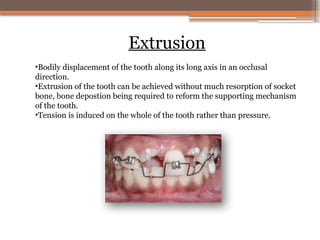 Mechanics of tooth movement, tooth movement in oral cavity | PPT