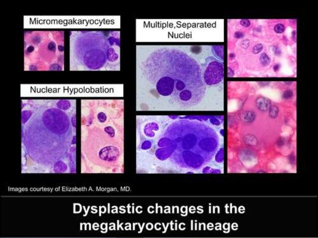 Myelodysplastic Syndrome