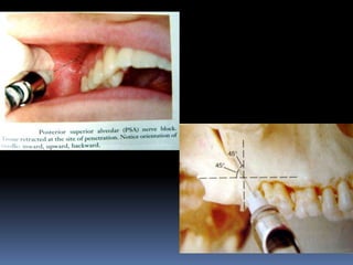 Maxillary Nerve Block High Tuberosity Approach