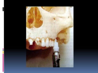 Maxillary Nerve Block High Tuberosity Approach