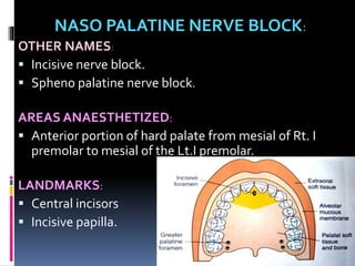 Nasopalatine Nerve Block