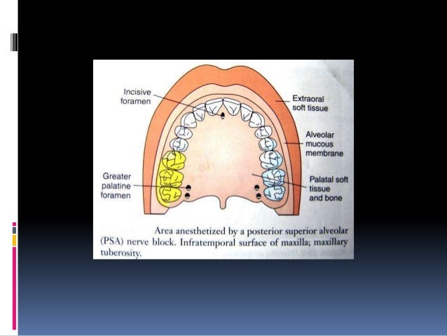Posterior Superior Alveolar Block
