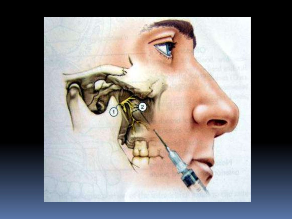 maxillary nerve block