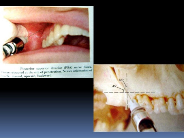Maxillary Nerve Block High Tuberosity Approach Clinical Techniques In