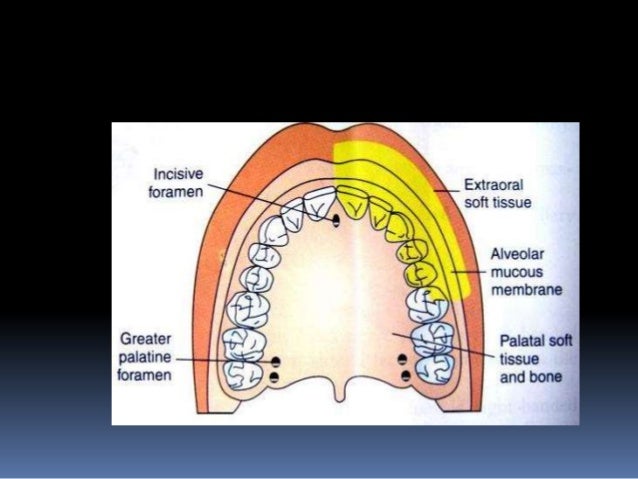 maxillary nerve block