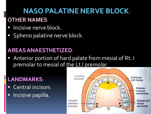 maxillary nerve block