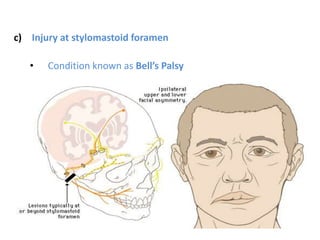 Stylomastoid Foramen