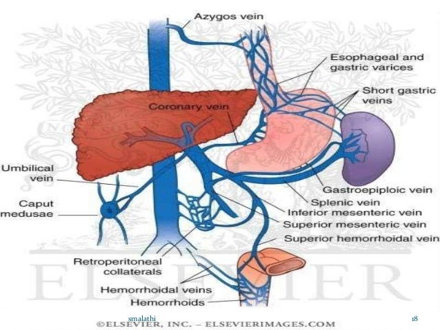 portal hypertension and upper G I bleeding