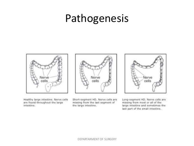 HIRSCHSPRUNG DISEASE...