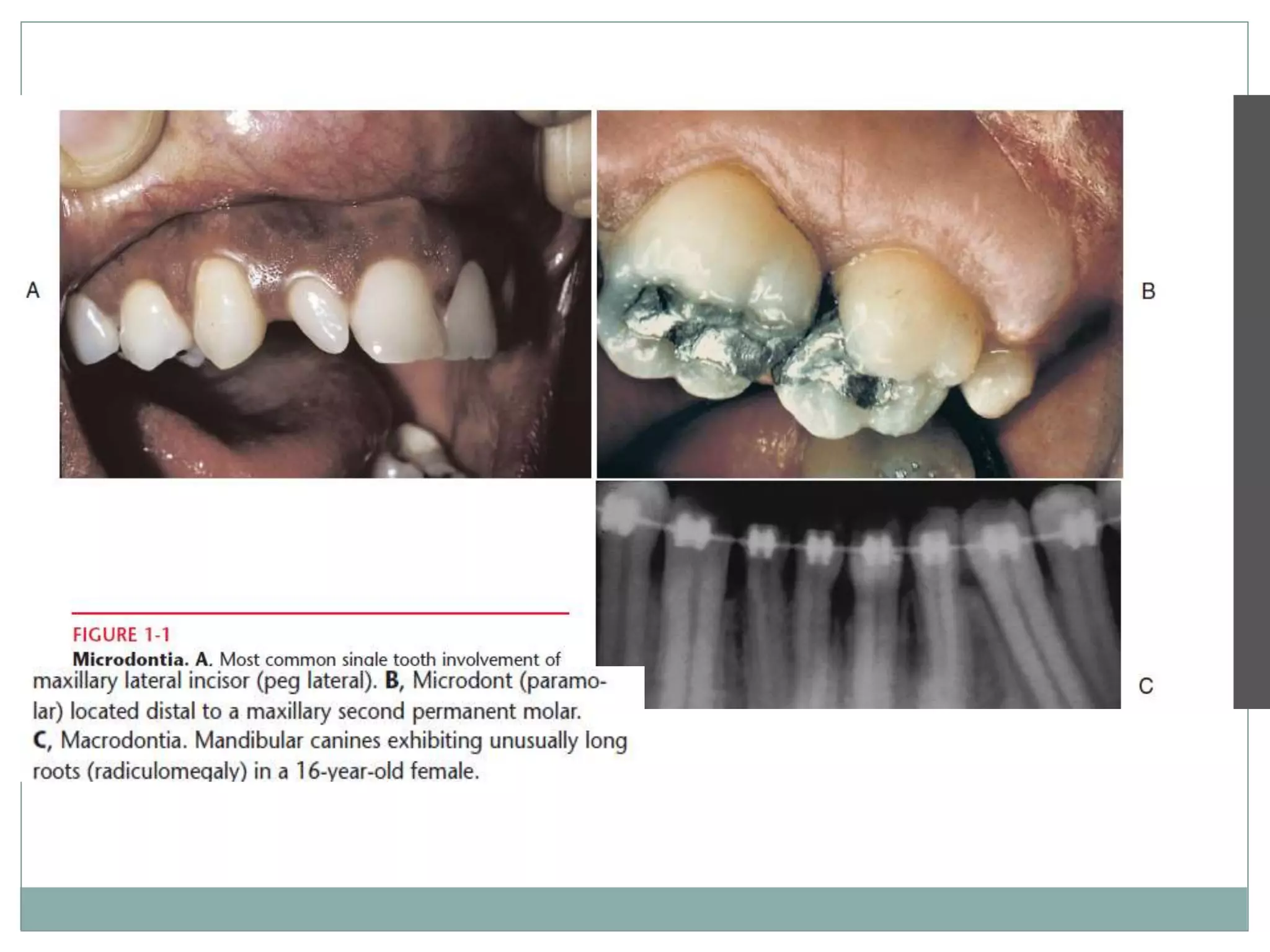 Dental anomalies | PPTX | Dental Health | Diseases and Conditions