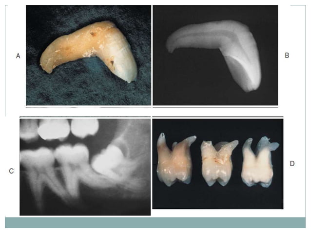 Dental anomalies | PPTX | Dental Health | Diseases and Conditions