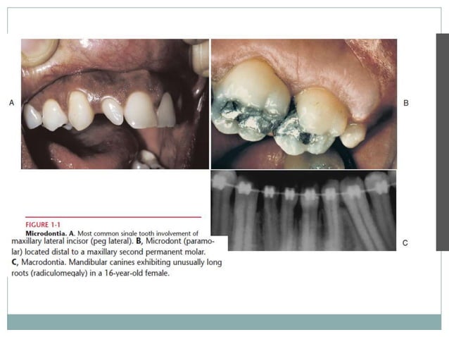 Dental anomalies | PPTX | Dental Health | Diseases and Conditions
