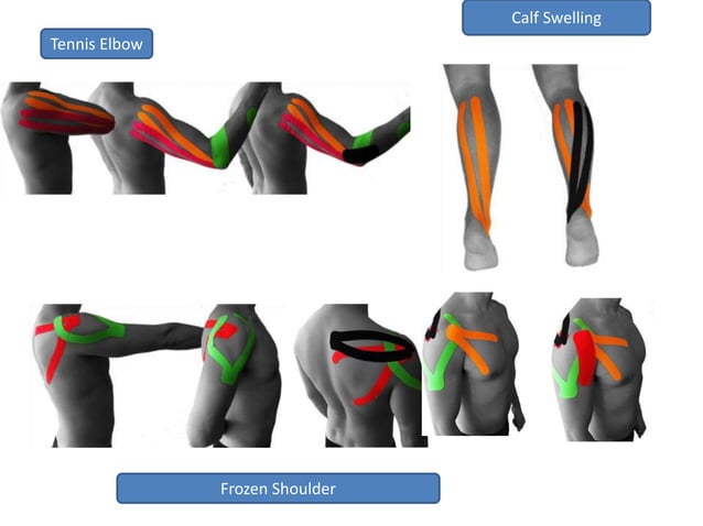 taping | PPTX | First Aid | Injuries