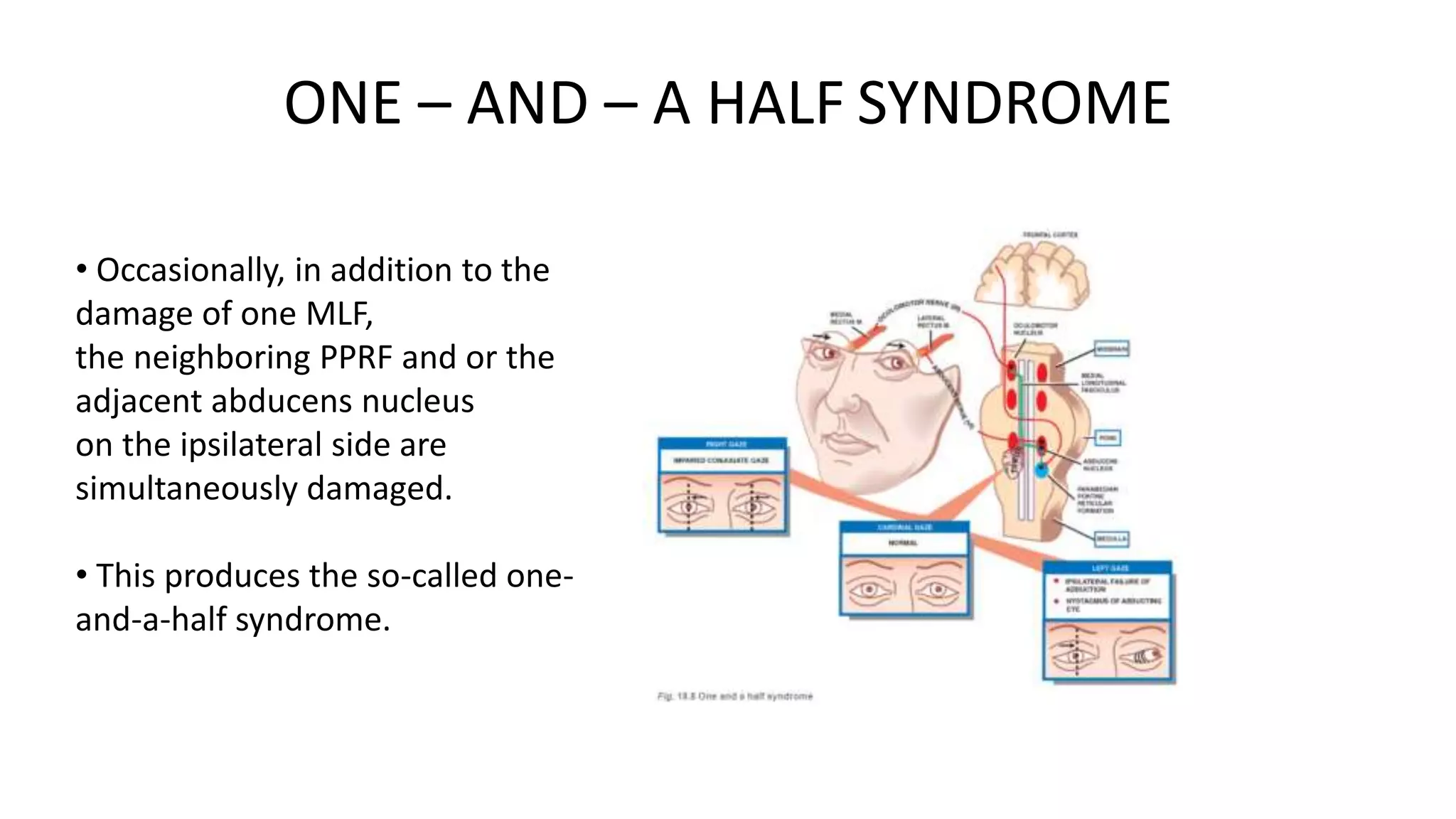 Supranuclear disorders of ocular motility | PPTX