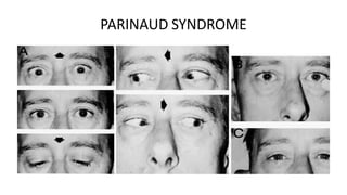 Supranuclear disorders of ocular motility | PPTX