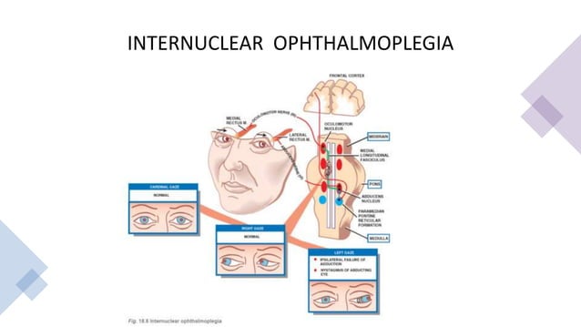 Supranuclear disorders of ocular motility | PPT