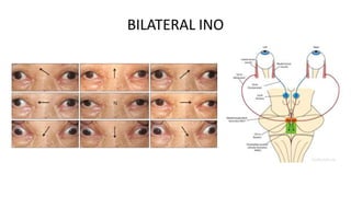 Supranuclear disorders of ocular motility | PPTX