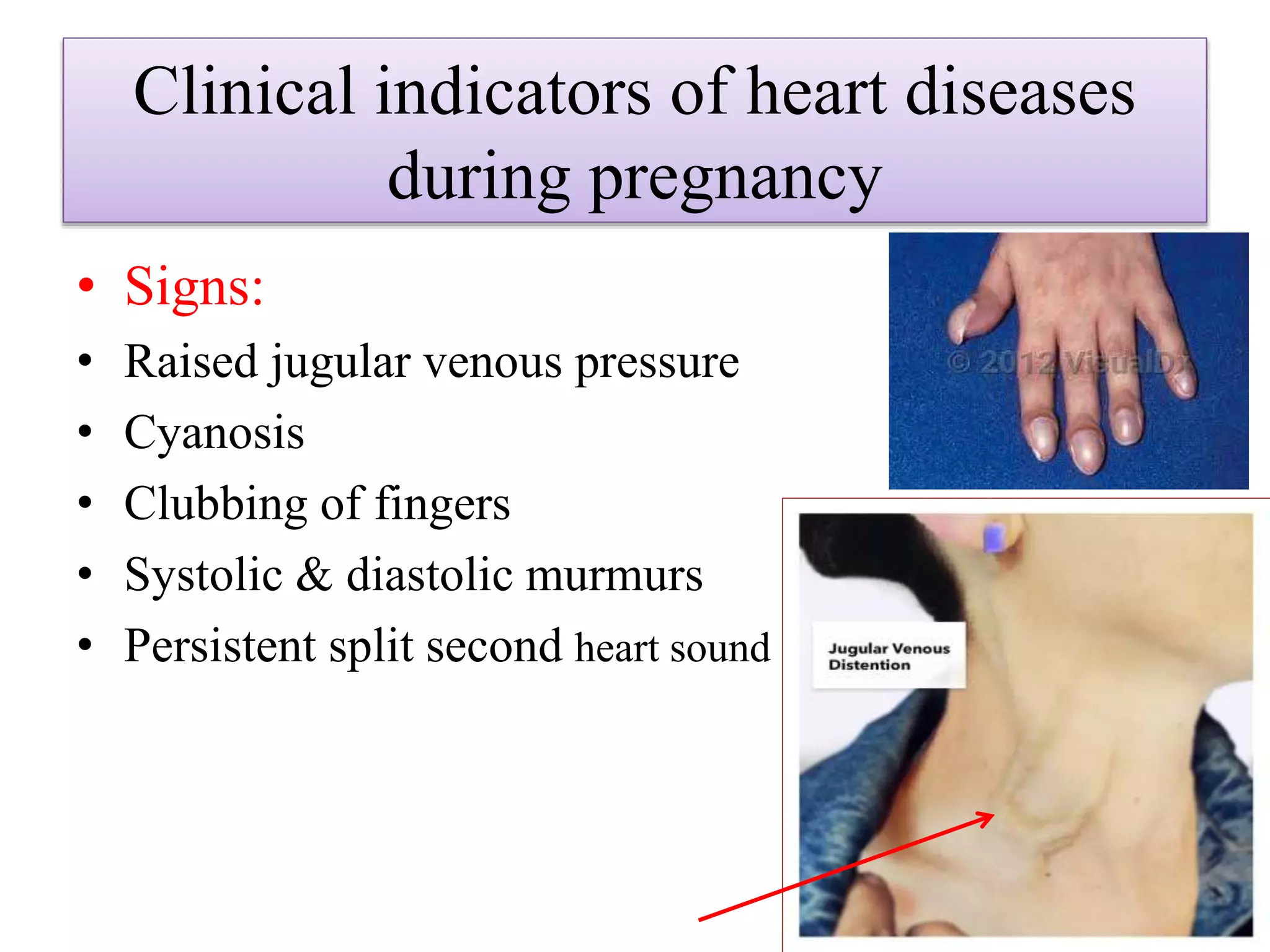 Heart diseases during pregnancy | PPT
