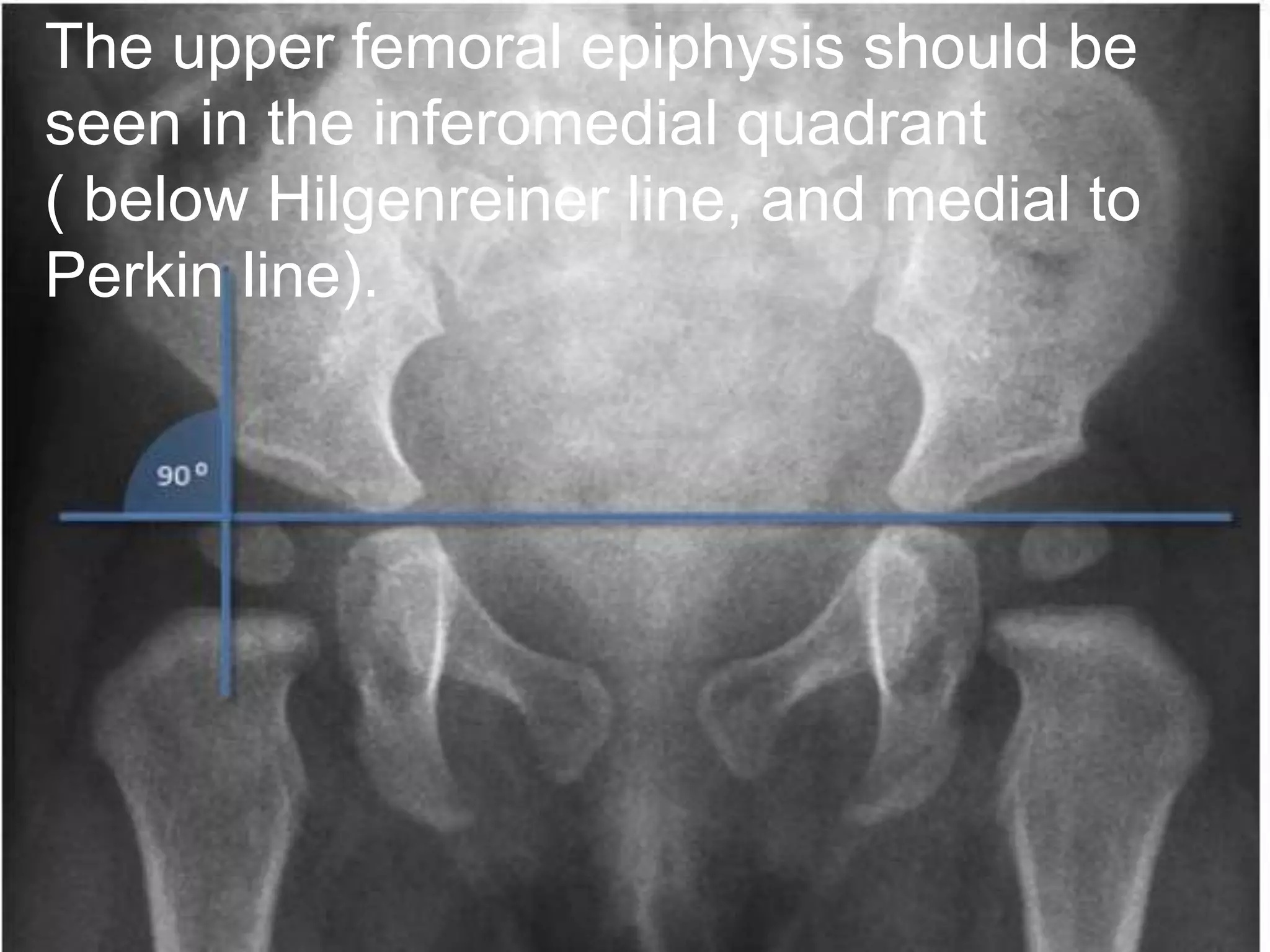 Pediatric hip radiology | PPTX