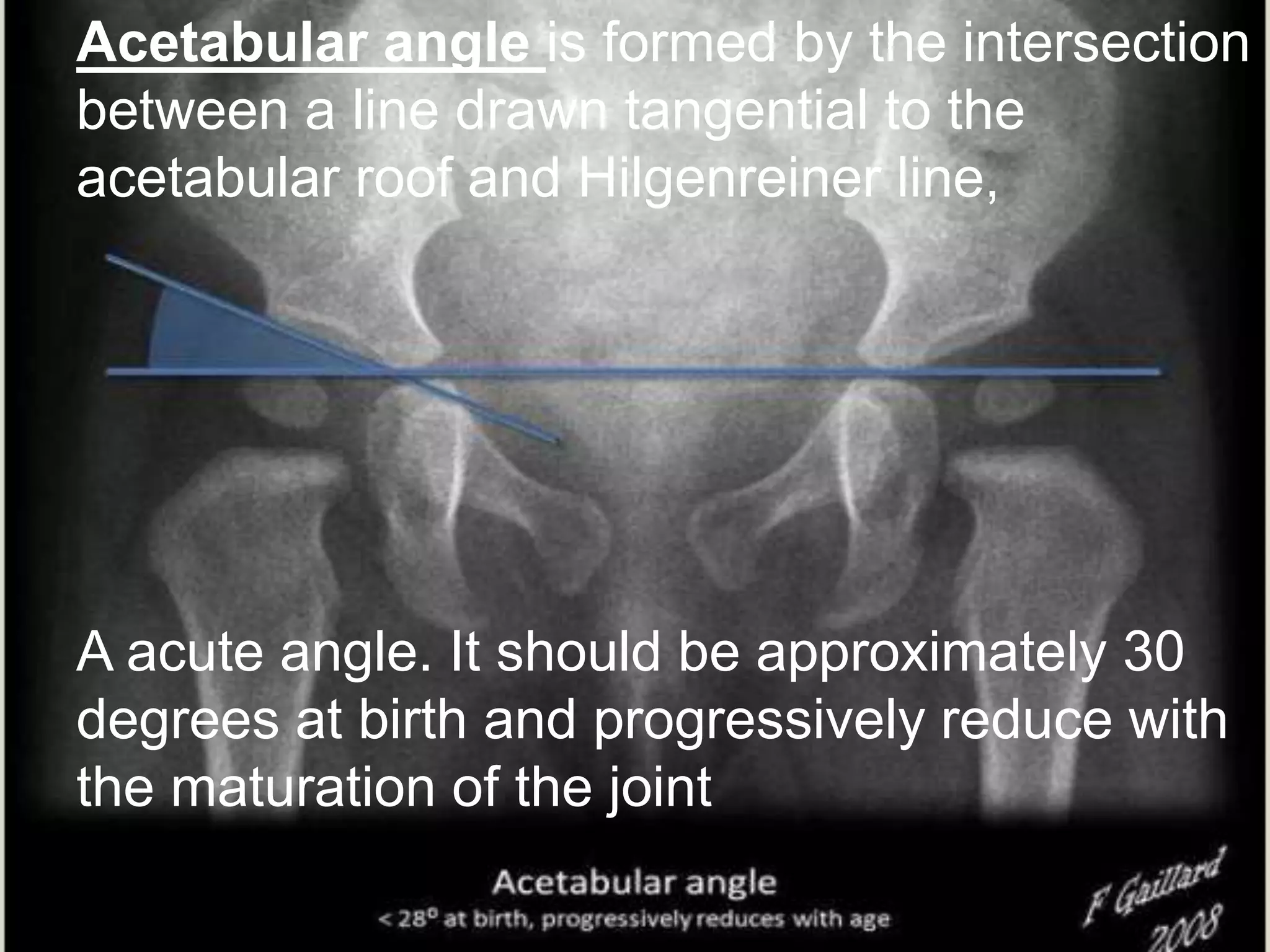 Pediatric hip radiology | PPTX