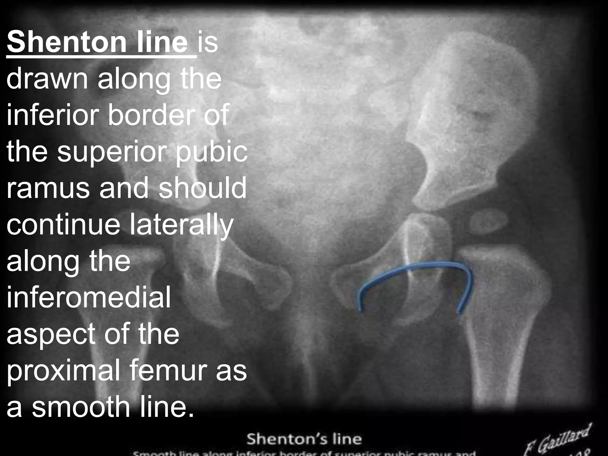 Pediatric hip radiology | PPTX