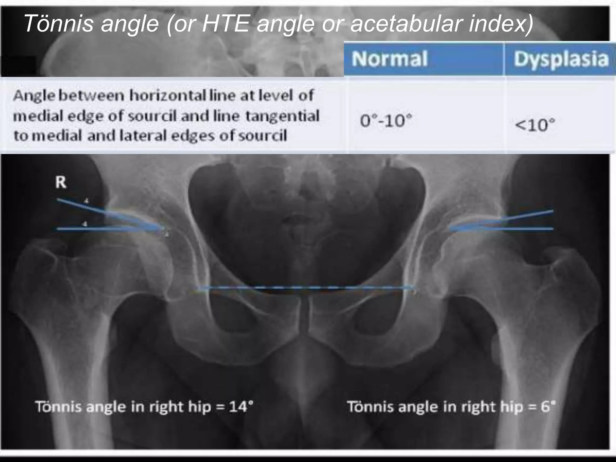 Pediatric hip radiology | PPTX