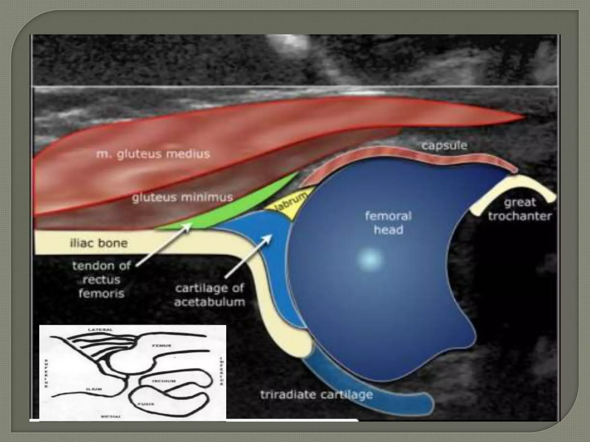 Pediatric hip radiology | PPTX