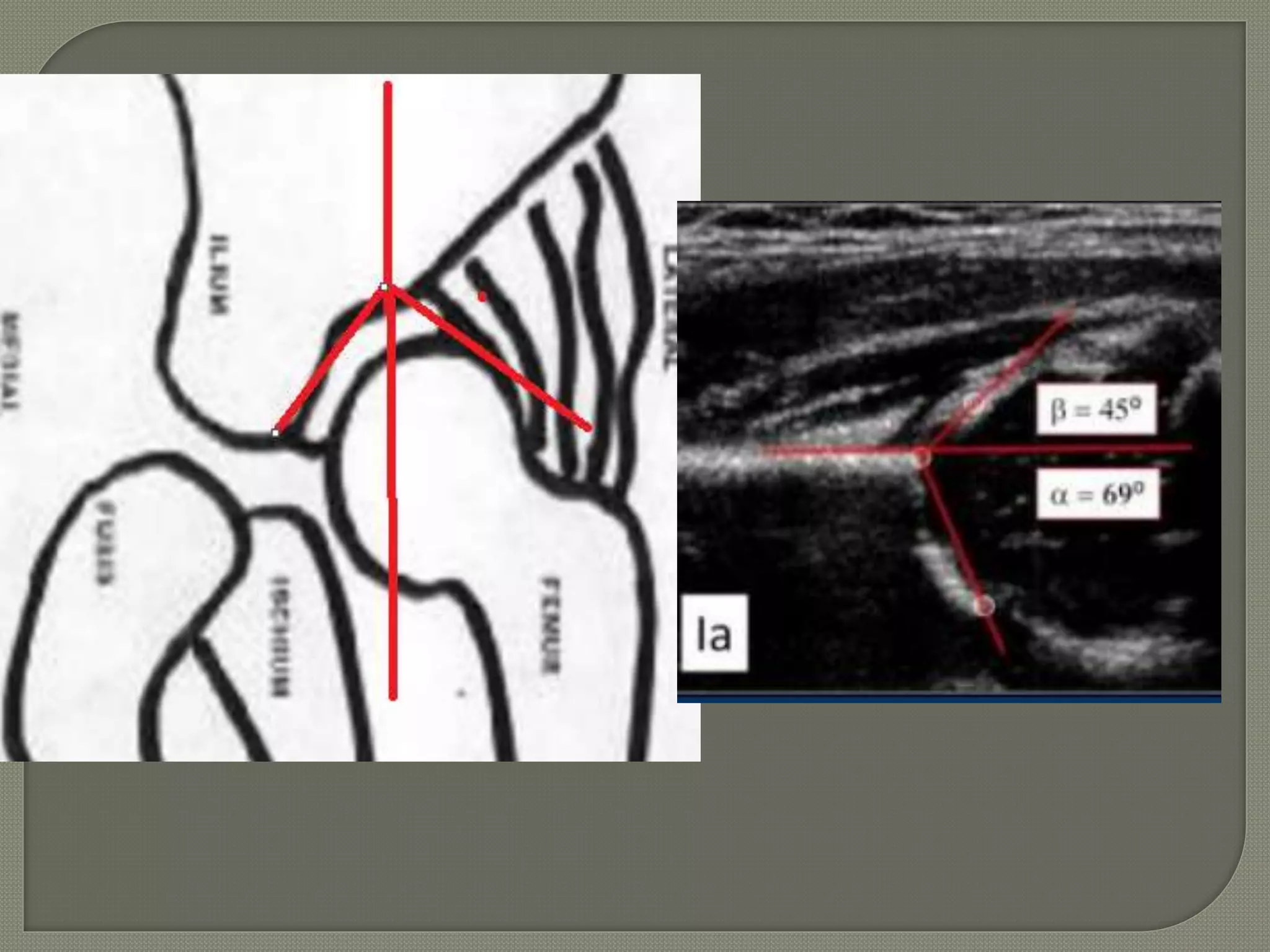 Pediatric hip radiology | PPTX