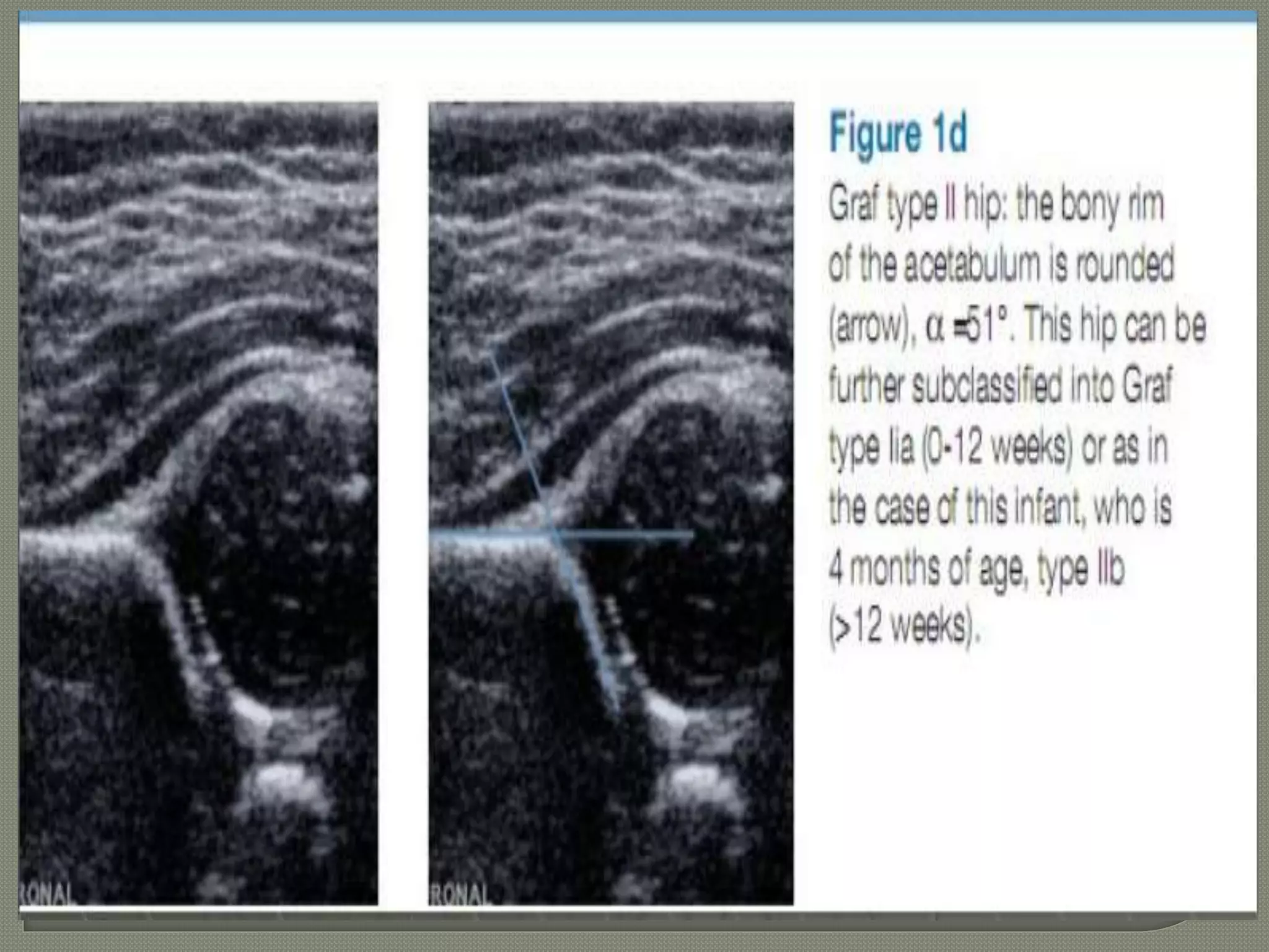 Pediatric hip radiology | PPTX