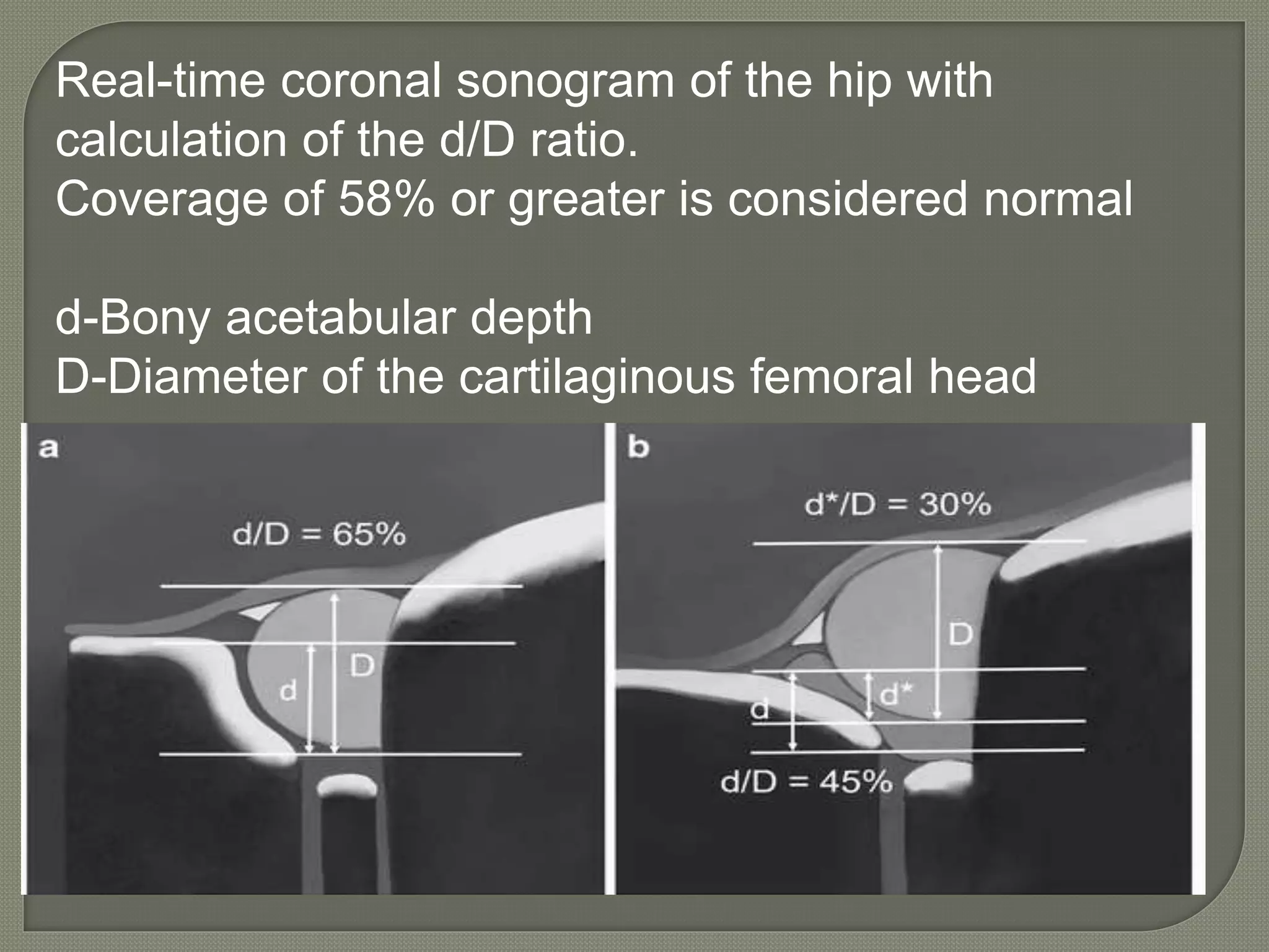 Pediatric hip radiology | PPTX