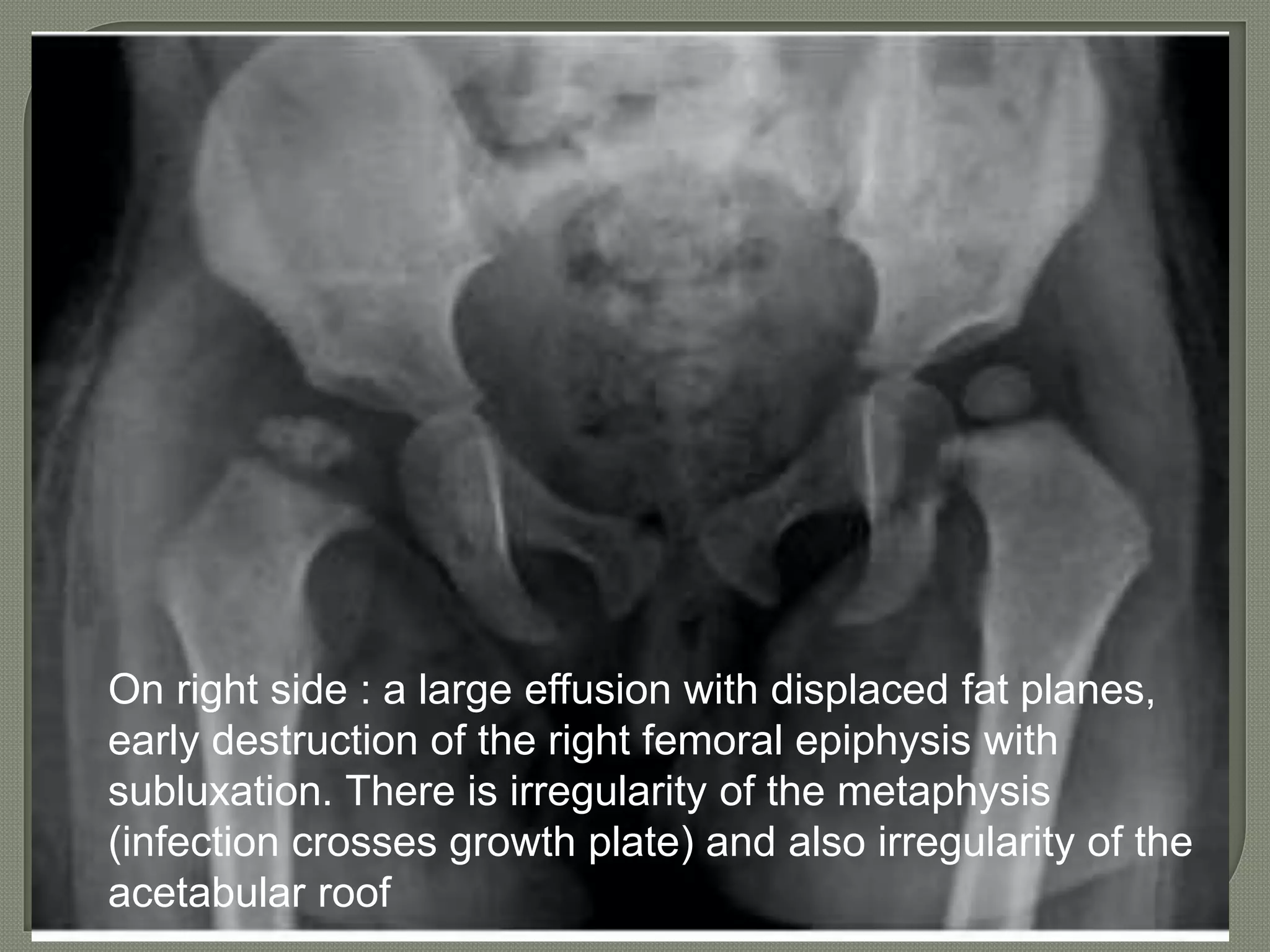 Pediatric hip radiology | PPTX