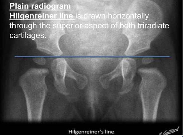 Pediatric hip radiology | PPTX