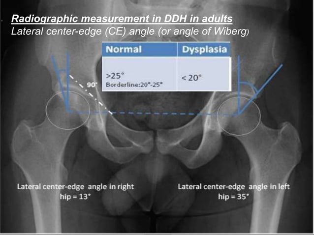 Pediatric hip radiology | PPTX