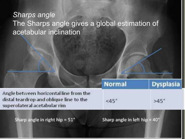 Pediatric hip radiology | PPTX
