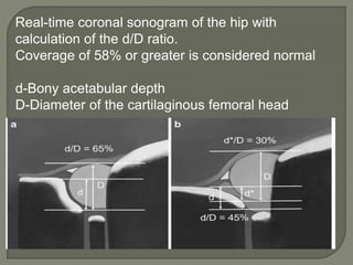 Pediatric hip radiology | PPTX