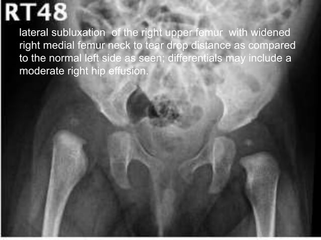 Pediatric hip radiology | PPTX