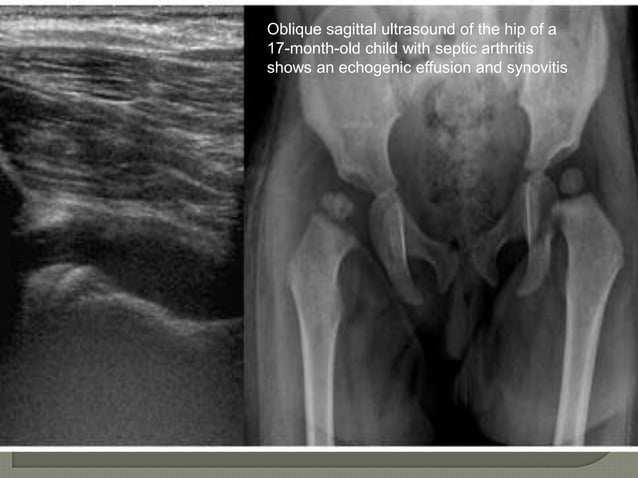 Pediatric hip radiology | PPTX