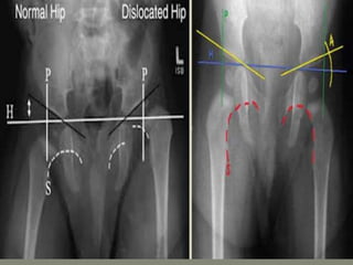 Pediatric hip radiology | PPT