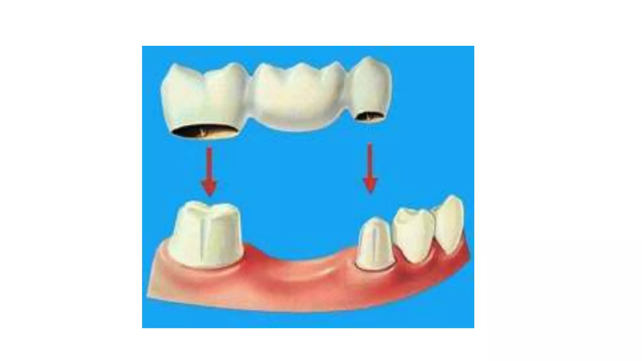 different designs of dental bridges | PPTX