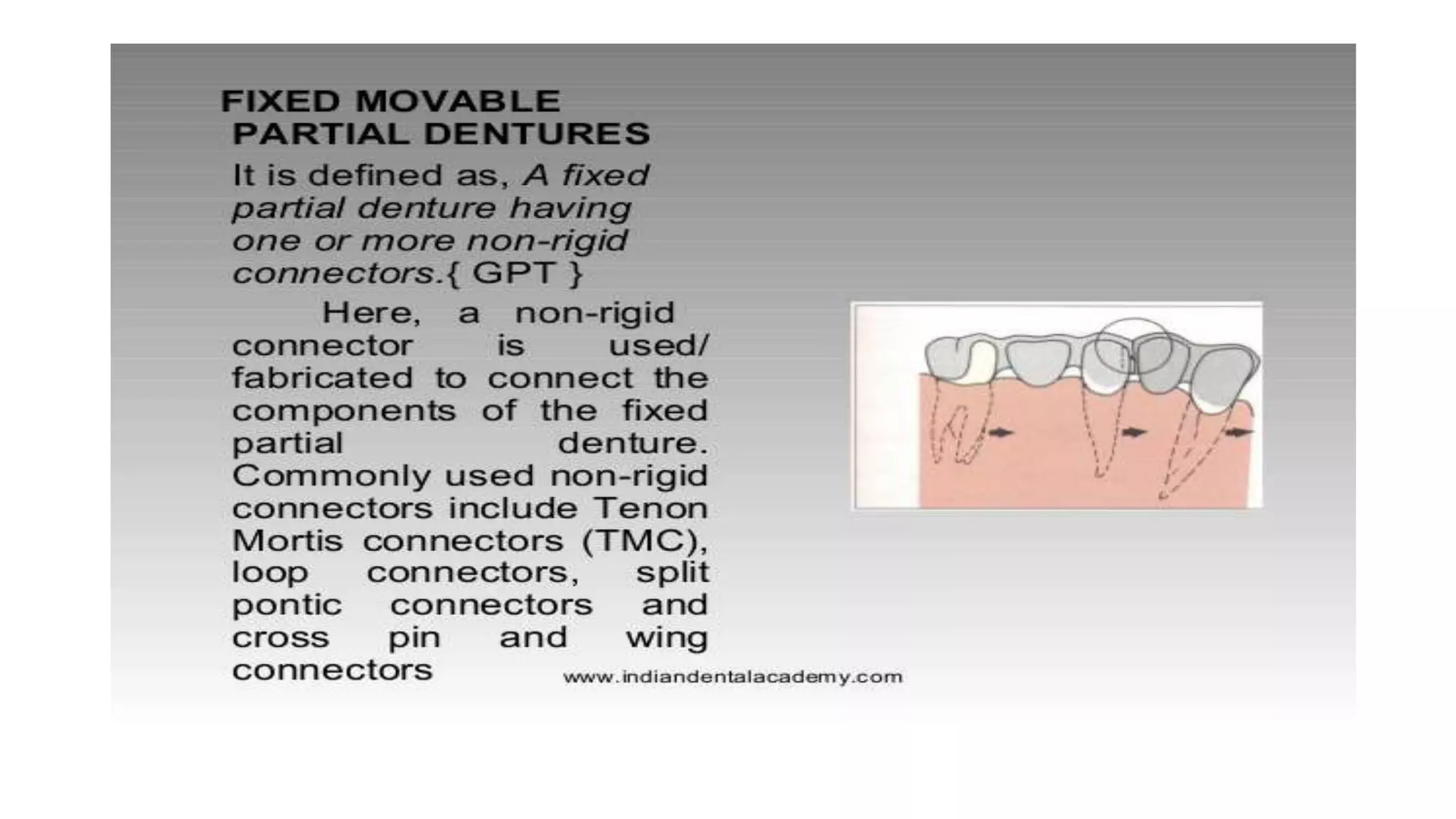 different designs of dental bridges | PPTX