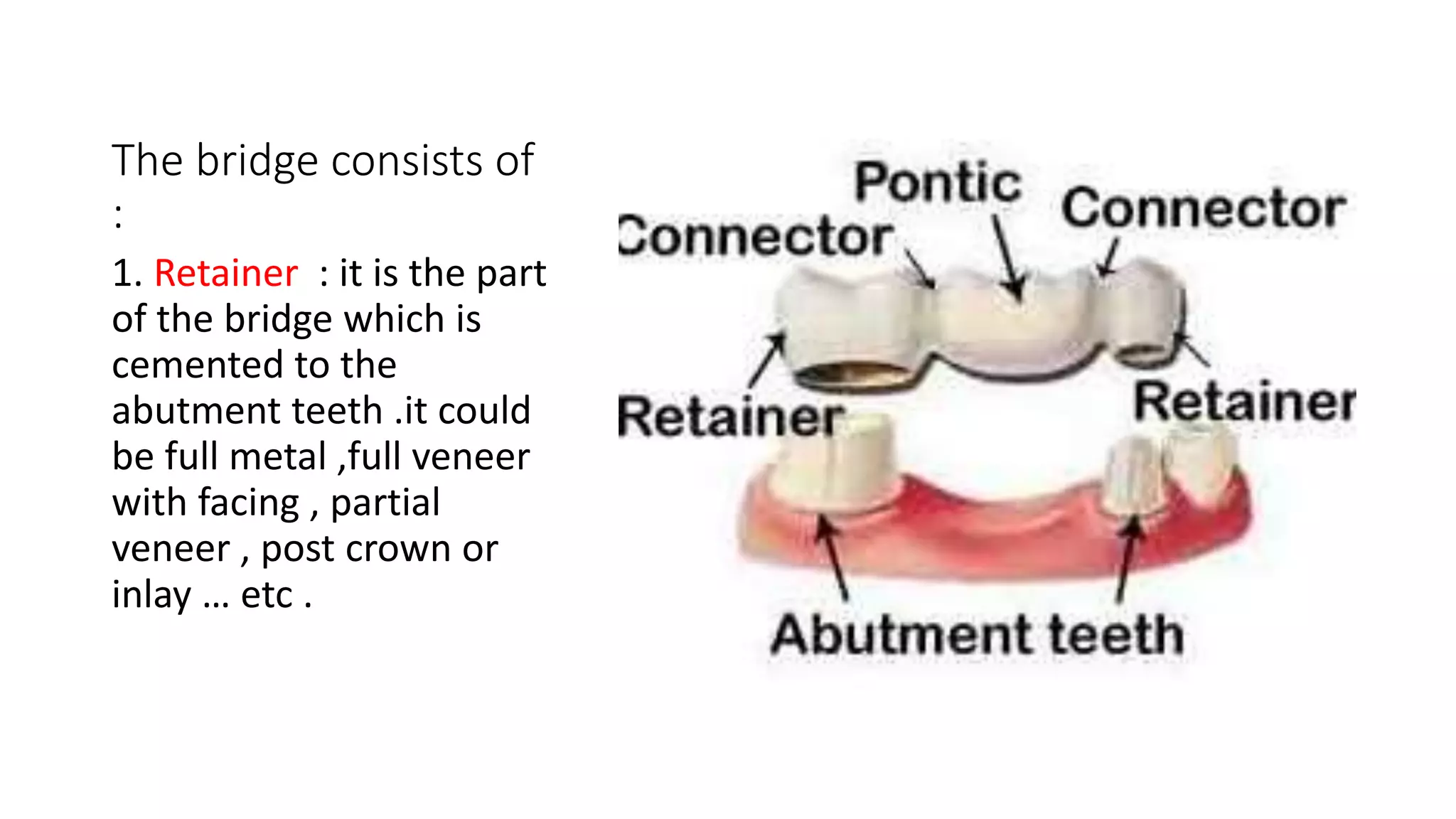 different designs of dental bridges | PPTX