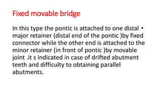 different designs of dental bridges | PPTX