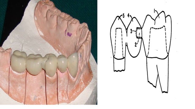 different designs of dental bridges | PPTX | Dental Health | Diseases ...