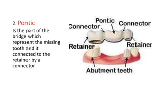 different designs of dental bridges | PPT