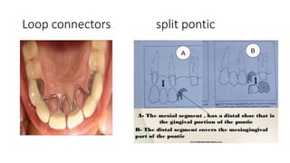 different designs of dental bridges | PPTX