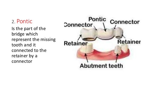 different designs of dental bridges