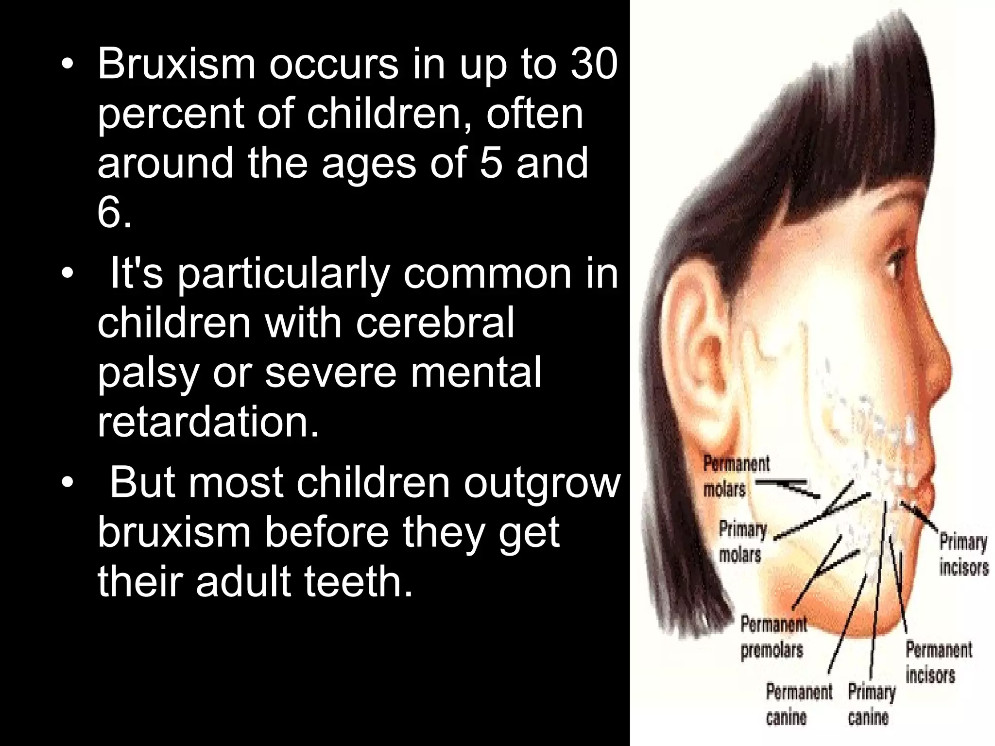 bruxism | PPT