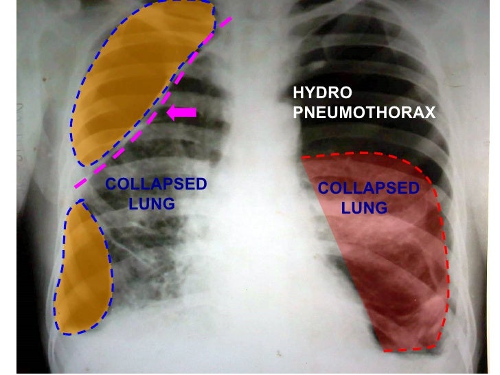 CXR: Pneumothorax / Pleural Thickening