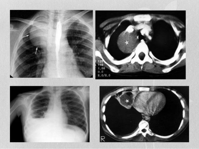 congenital lung disorders : radiology