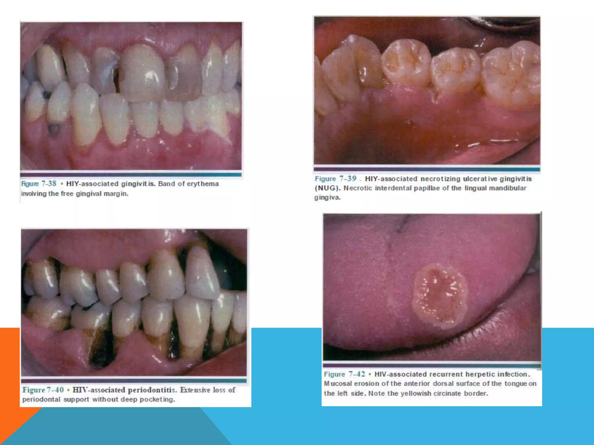 viral infections of the oral cavity | PPTX